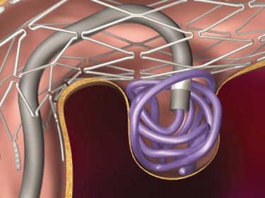 Aneurysms – SNIS